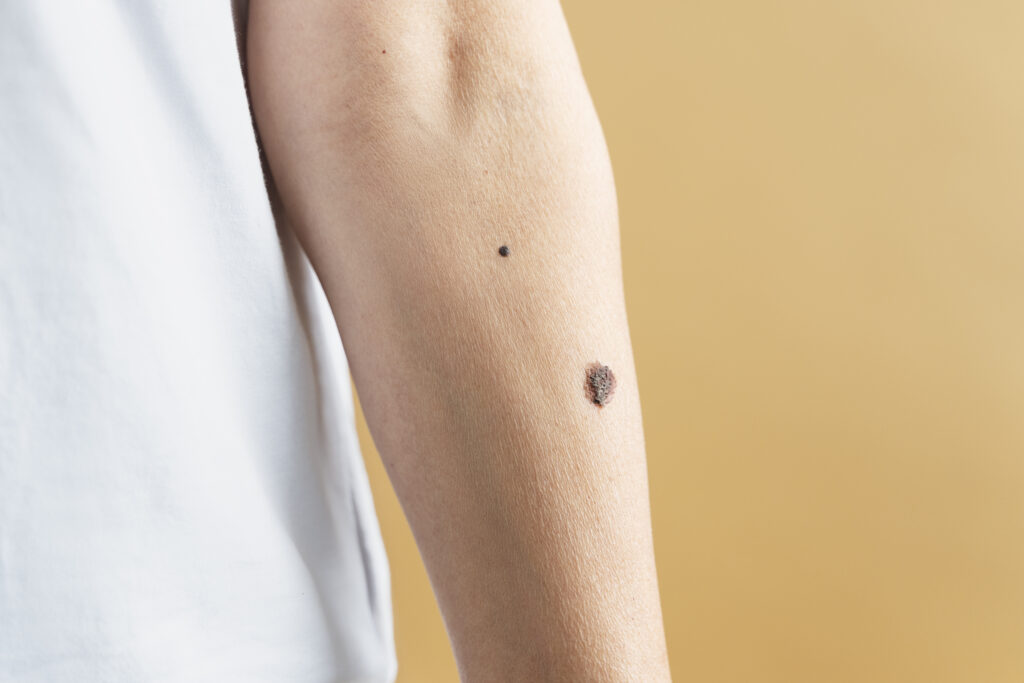 What Causes Skin Warts? - Nutri Active