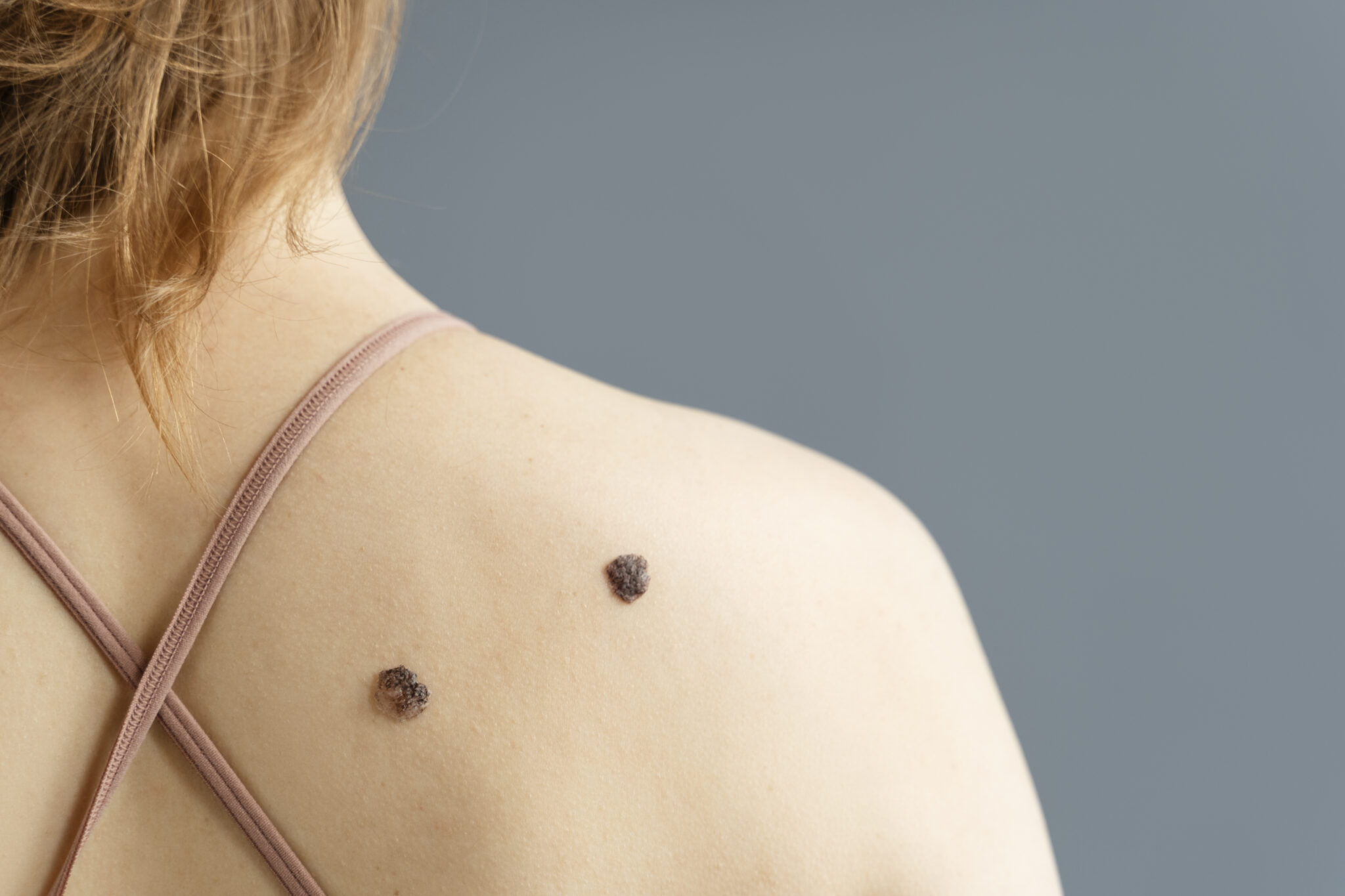 How to Stop Moles from Forming on Your Face - Nutri Active