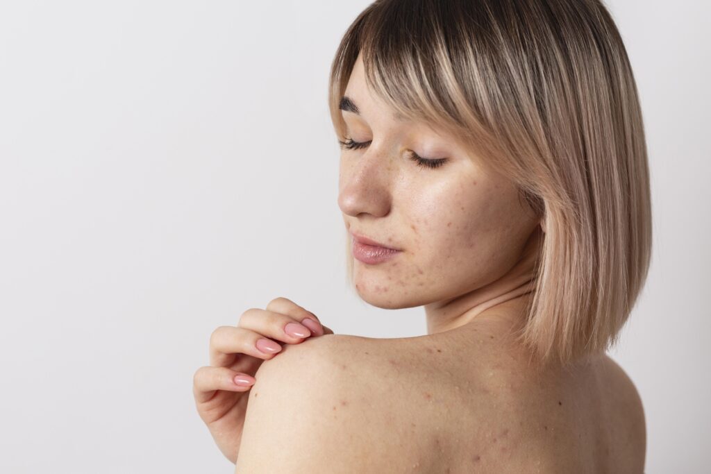 Fatty Liver Symptoms on Skin - Nutri Active